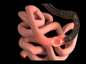 Balloon Enteroscopy – Central Melbourne Specialists